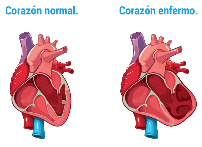 Recomendaciones para pacientes con falla cardiaca – Los Comuneros