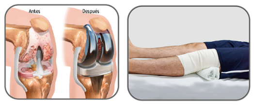 Tipos De Operacion De Rodilla – Tratamiento y recuperación de artrosis ...